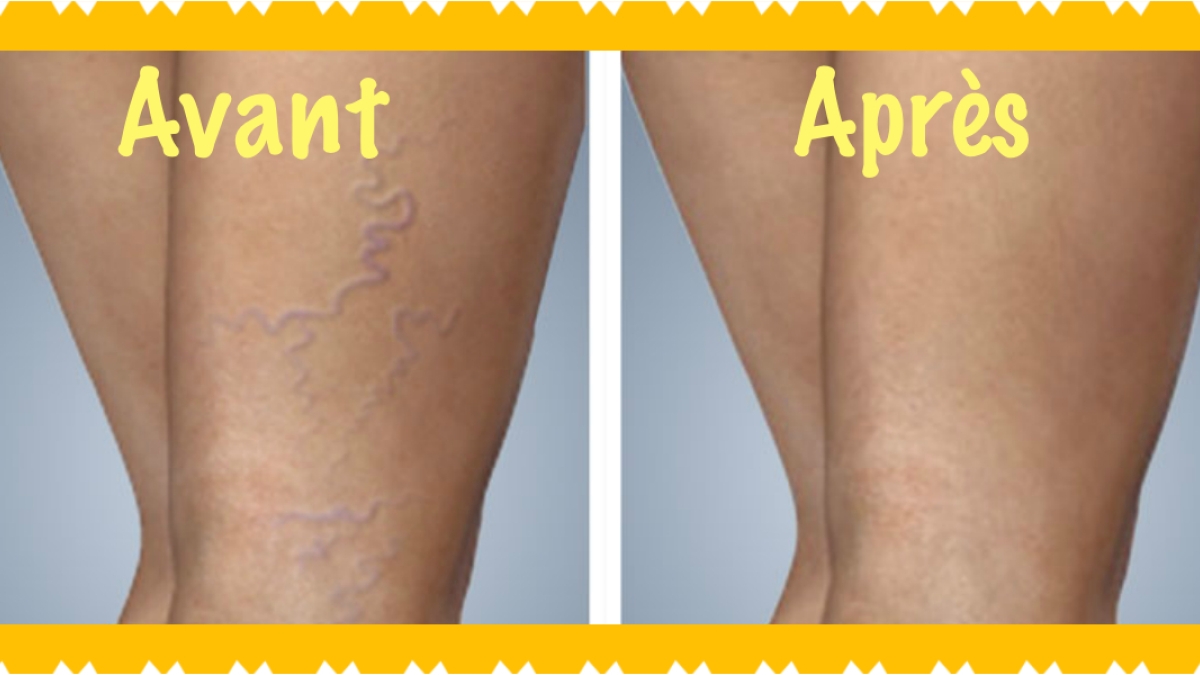 2 solutions miracles pour lutter contre les varices à la maison